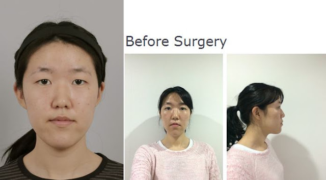 ID Hospital Korea: Japanese girl making her dream come true by plastic ...