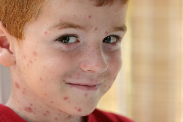 Perpetual Preparedness: Chicken Pox