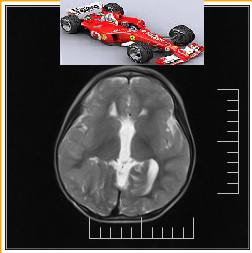 Racing Car Sign-MRI - Sumer's Radiology Blog