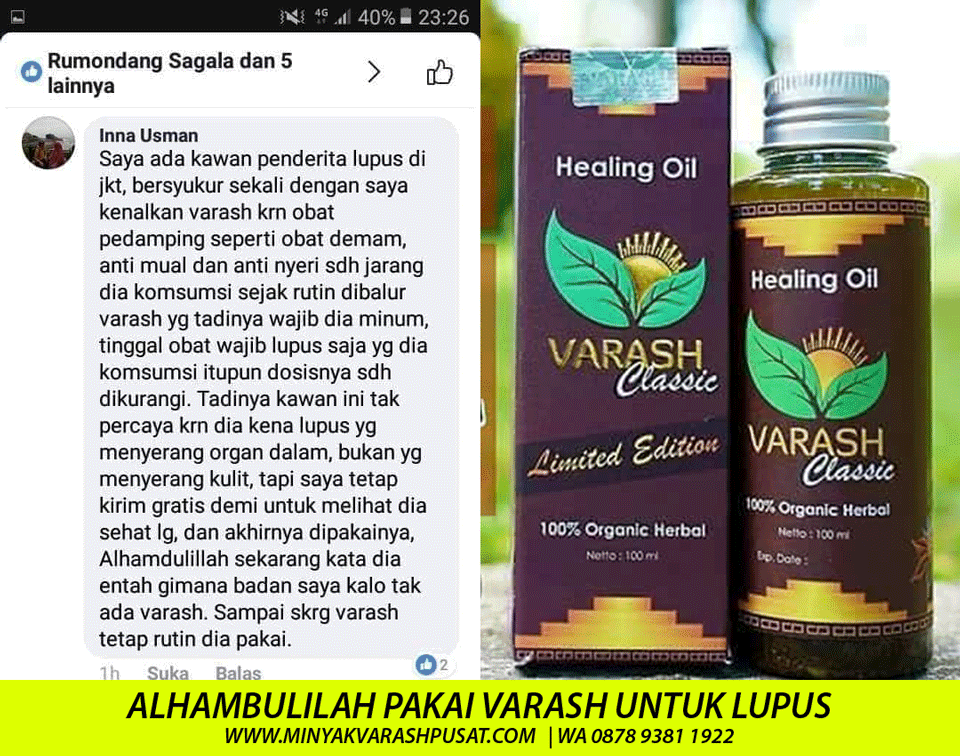 LUAR BIASA, Minyak Varash Classic untuk Lupus Sangat Terasa