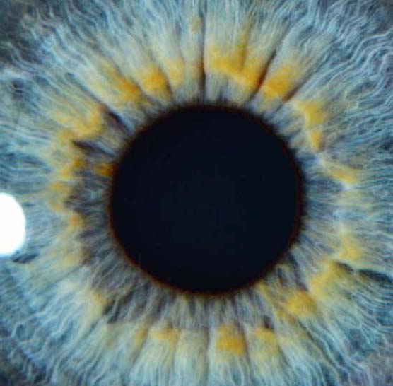 Modern & Multidimensional Iridology: Radial Furrows in Multidimensional ...