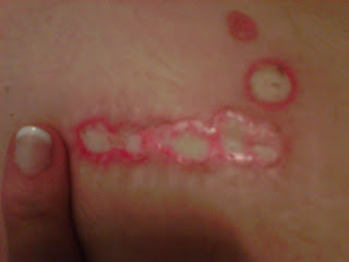 Self Injury Journey: Cigarette Burns Starting to Heal