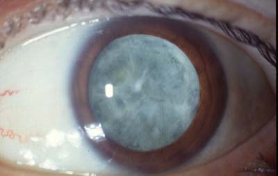 Deformutilation: Cataracts