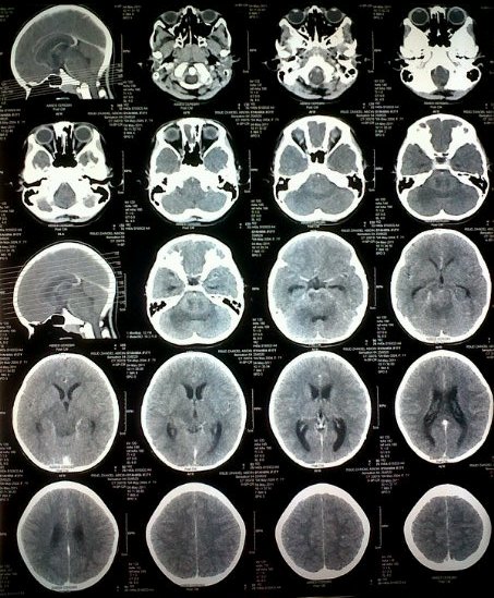 Iklas iryadi iklas berbagi: ABSES OTAK (preskas)