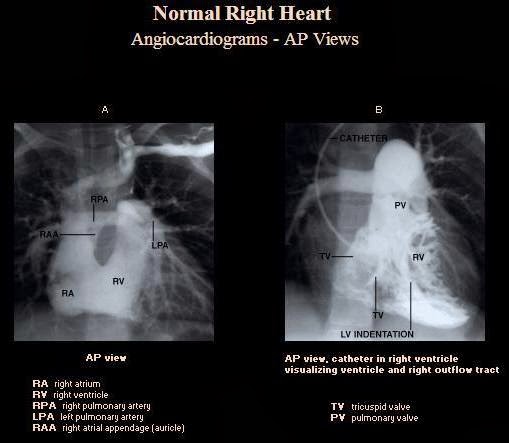 Melihat Jantung pada Proyeksi Rontgen (Bagian II: Angiocardiogram)