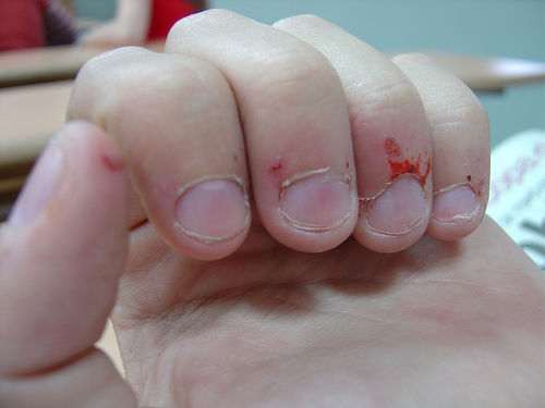 OUR BODY TALKS: HOW DO I STOP EATING MY NAILS?