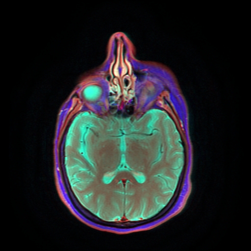 Nevit's blog: Color MRI - Lymphoma of the Neck