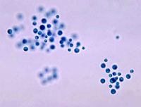 ENFERMEDADES TRANSMISIBLES: CRIPTOCOCOSIS