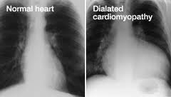 Ischemic Dilated CardioMyopathy + Diabetes type 2: (Ischemic) Dilated ...
