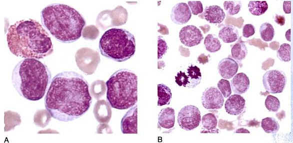 FICHERO DE HEMATOLOGIA: LMA - M4 MIELOMONOCITICA