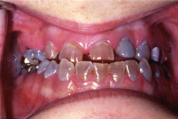 Rylan S. Banks: Osteogenesis imperfecta Research