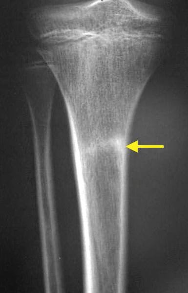 Traumatología y...: Fracturas por estrés