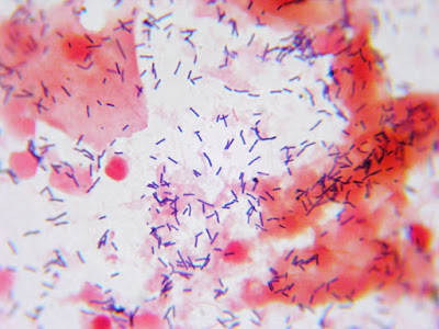 Fun With Microbiology (What's Buggin' You?): Bacterial Vaginosis