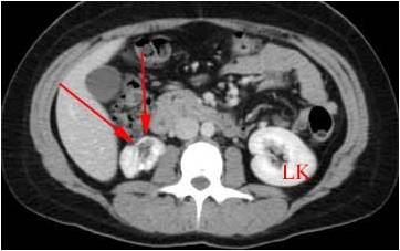 Radiologist For Ever: Renal rule 18 : Reflux nephropathy