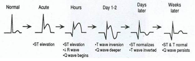 Infark Miokardium Akut dan Evolusinya | INA - ECG