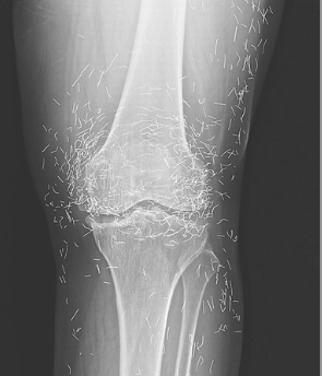 BloodCure from Dare To Be Vital: Acupuncture with Gold for Knee ...