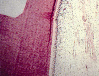 Pulpal Reaction to Glass-Ionomer Cements - Endodontics and Oral ...