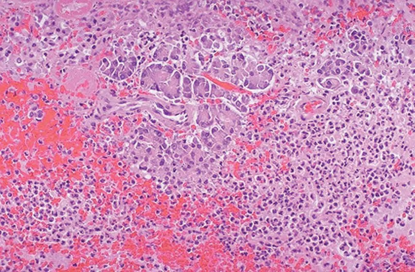 Histopatología: PATOLOGÍA DEL PANCREAS