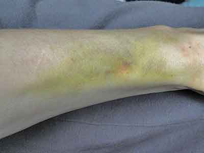 Frozen Woman: Life with Rheumatoid Arthritis: IV Bruise