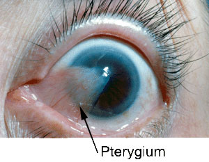 Doctors Gates: Photo description of Pterygium of the eye