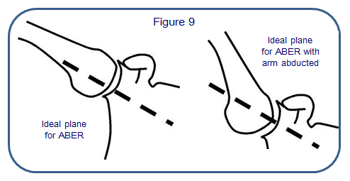 MRI Protocols: ABER Protocol for MRI Shoulder