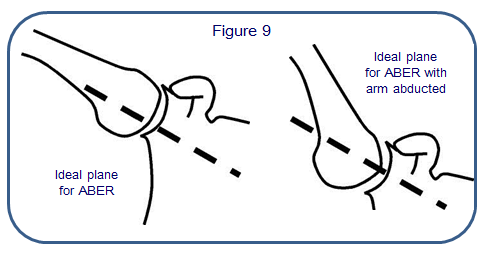 MRI Protocols: ABER Protocol for MRI Shoulder