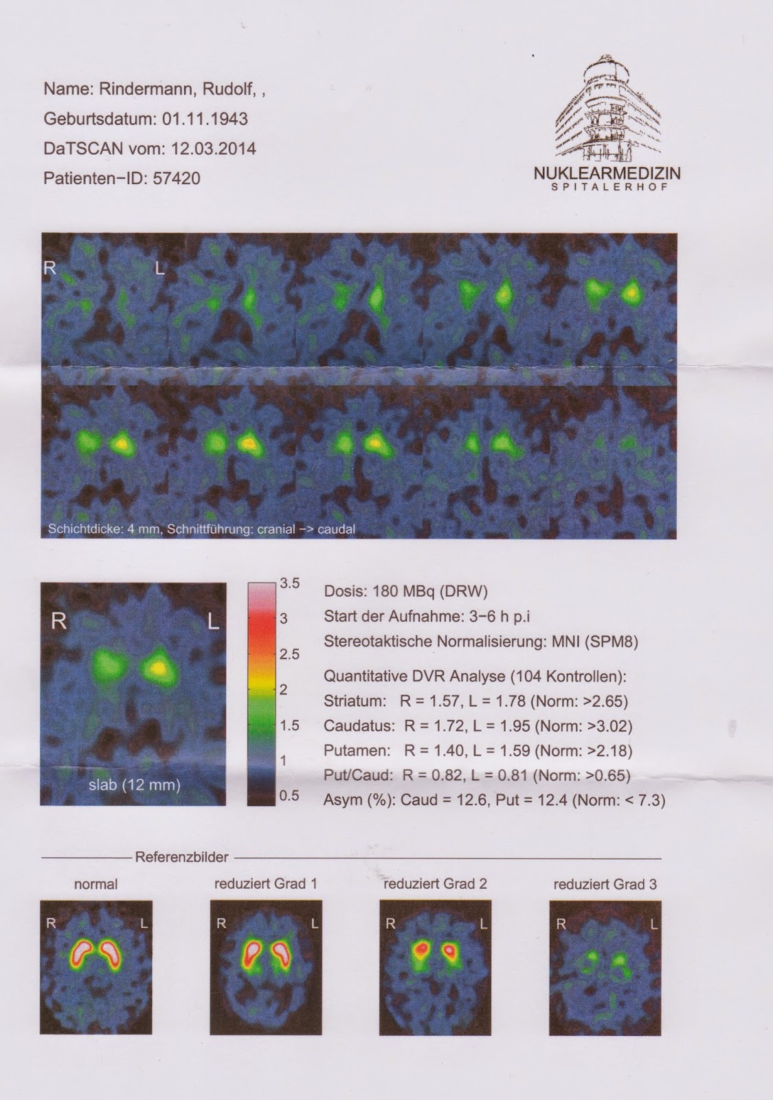 Parkinson Coaching: Neueste DaTSCAN-Untersuchungsergebnisse des ...