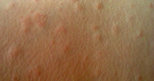 Penyakit Kulit Campak, Gejala, Penyebab & Cara Mengatasi