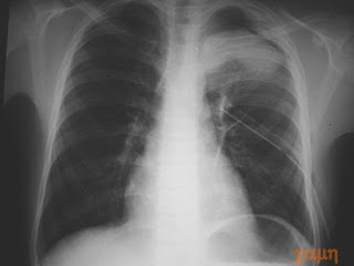 TRAUMA PULMONAR