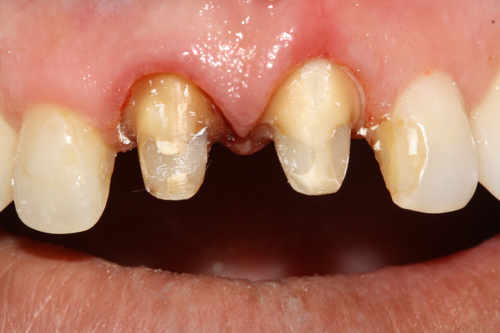 Estetica en Anterior en Prostodoncia FIja Moderna : Ponticos Ovoides