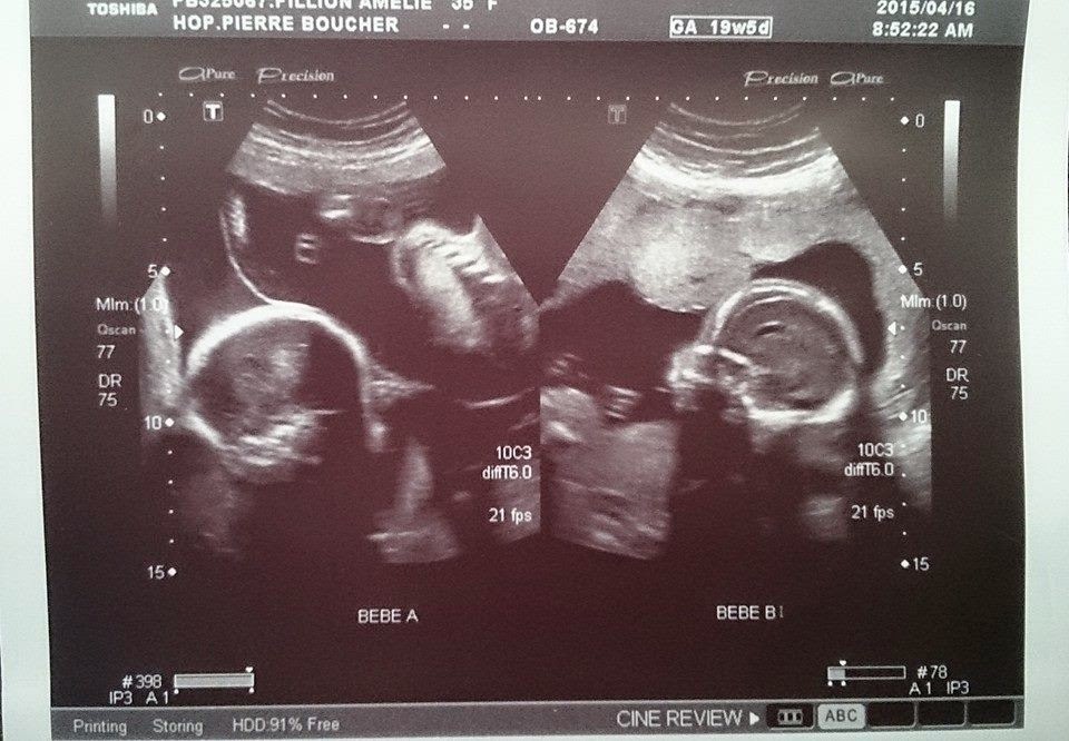 Déroulement de l'échographie morphologique double! ~ Quatre ptits prouts