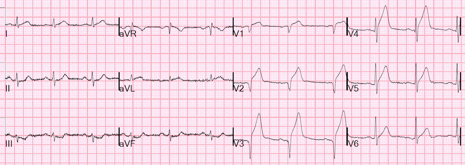 Pathway Stemi