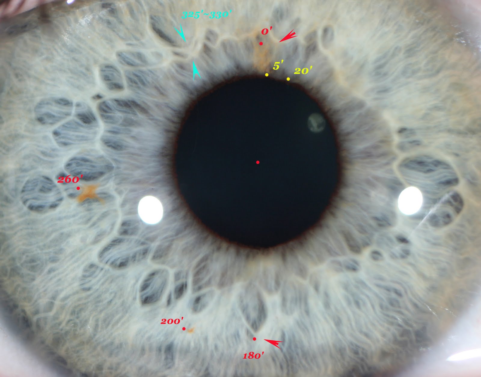Modern & Multidimensional Iridology: Lymphatic Iris Constitution ...