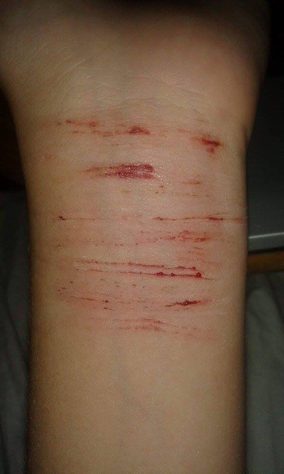 D-Boy: Samookaleczanie i moja depresja