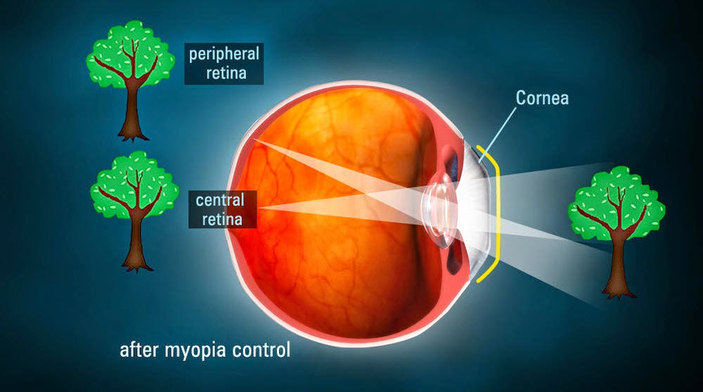 Myopia (Nearsightedness)