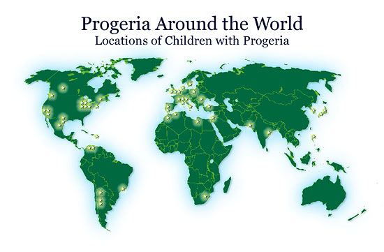 Progeria: early ageing condition in children now has a breakthrough cure