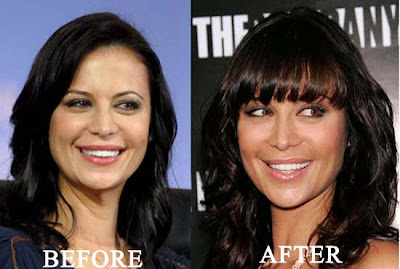 Catherine Bell before and after plastic surgery |Alia Bhatt