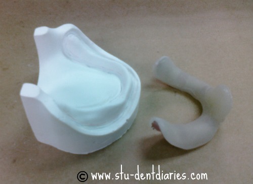 Stu-DENT Diaries: Custom Tray, Record Base and Wax Rim