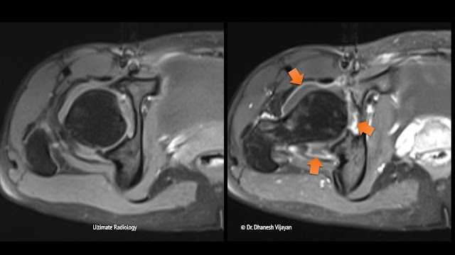 Ultimate Radiology : Septic arthritis of hip joint