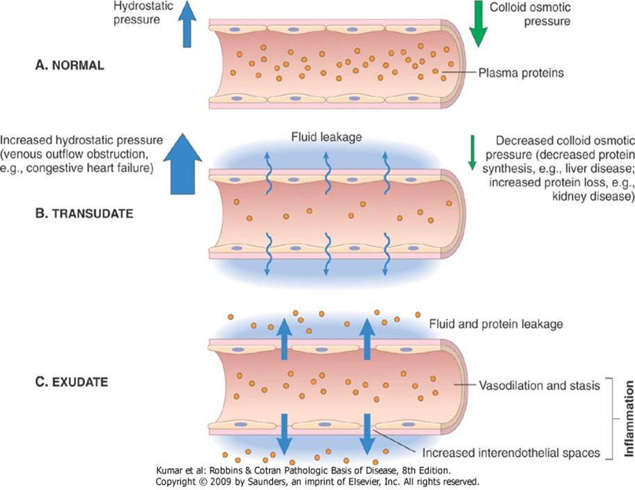 Transudate vs. Exudate | Remember | Pinterest | Search, Google Search ...