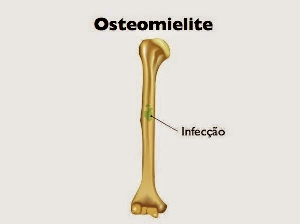AnatoCrazy: OSTEOMIELITE: Entenda um pouco sobre a doença.