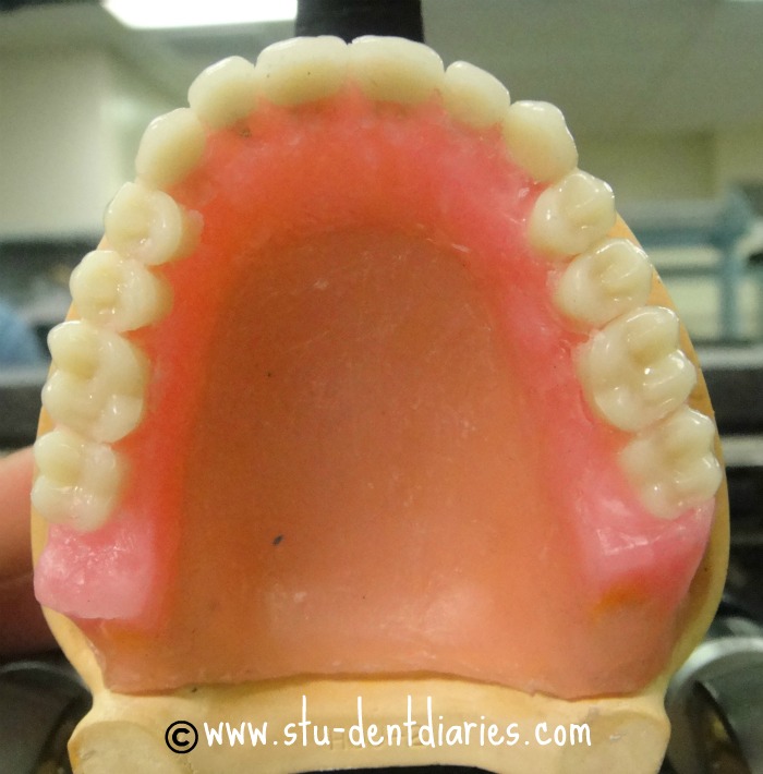 Stu-DENT Diaries: Removable Prosthodontics: Complete Dentures