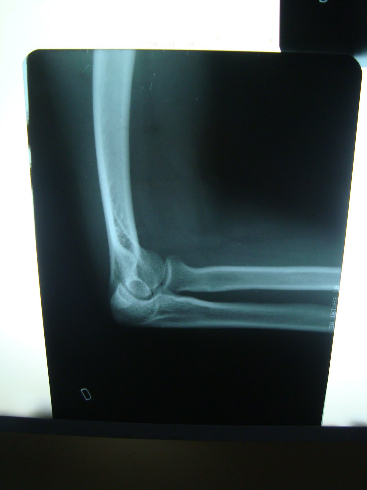 RADIOLOGIA 1: Codo- cabeza del radio- proyección lateral- latero-medial ...