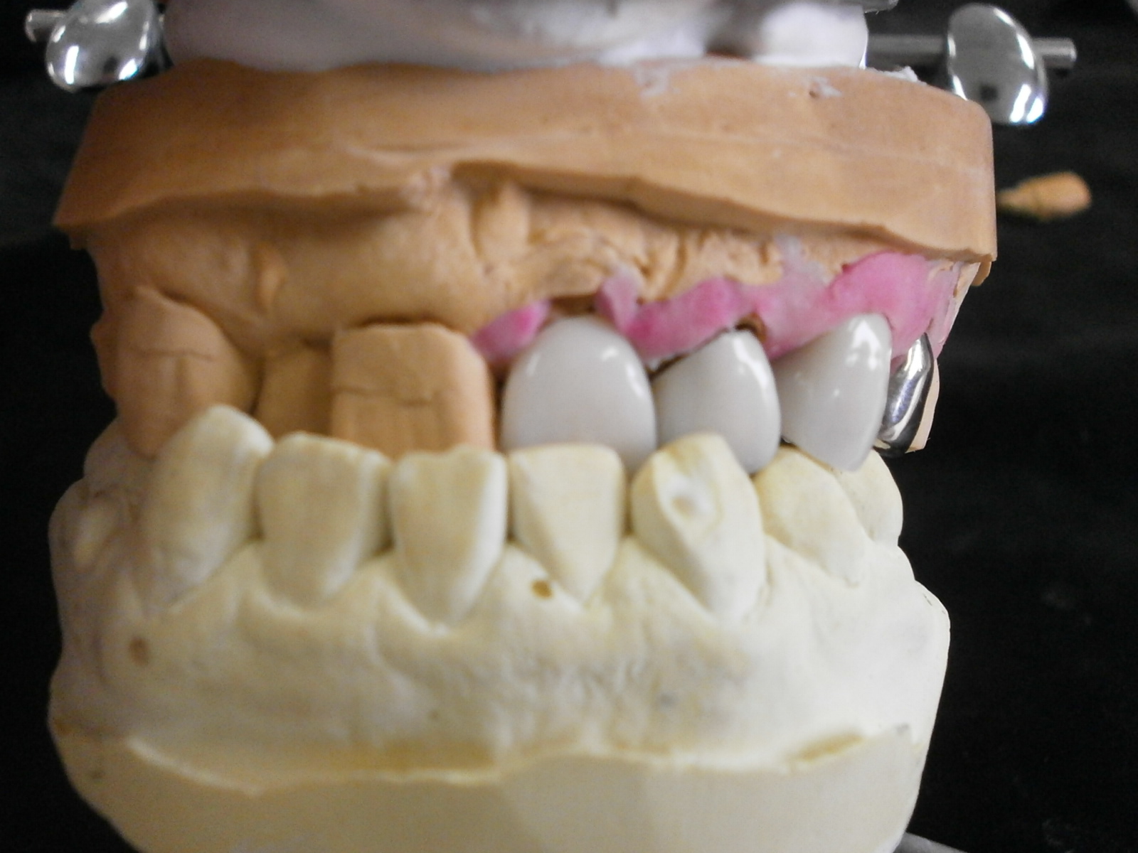 髙田朝（Hajime Takada）のオーダーメイド歯科技工物の紹介 Introduction of custom-made dental ...