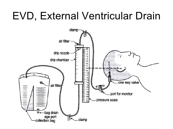 Jaga kesihatan anda ketika di puncak kerjaya kerana STROK akan ...