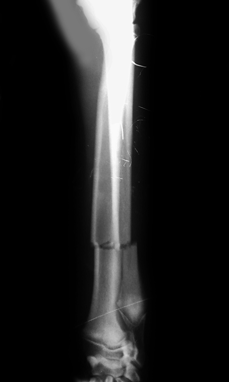 ARTROVET: Fractura de cúbito y radio