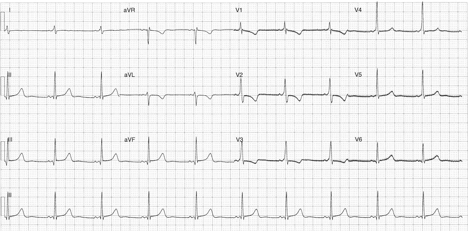 ECG of the Week: ECG of the Week - 22nd August 2016 - Interpretation