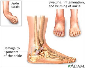 Free For Health: Sprained Ankle Symptoms - Is It Broken Or Sprained?