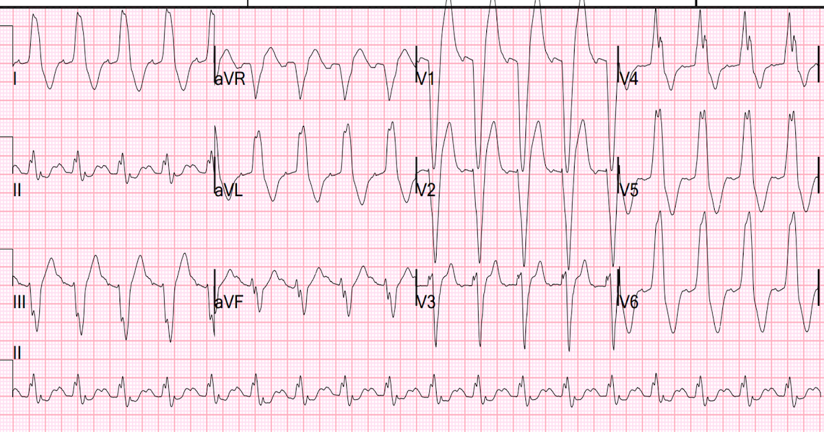 Dr. Smith's ECG Blog: Acute Pulmonary Edema, Respiratory Failure, and LBBB