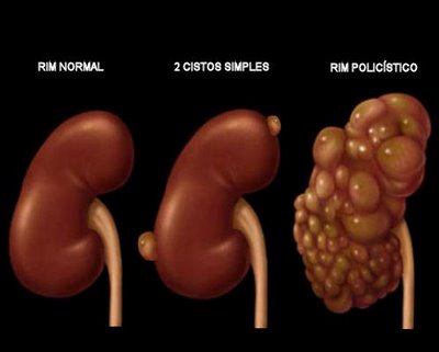 Deixa que Eu Cuido: Cálculo Renal